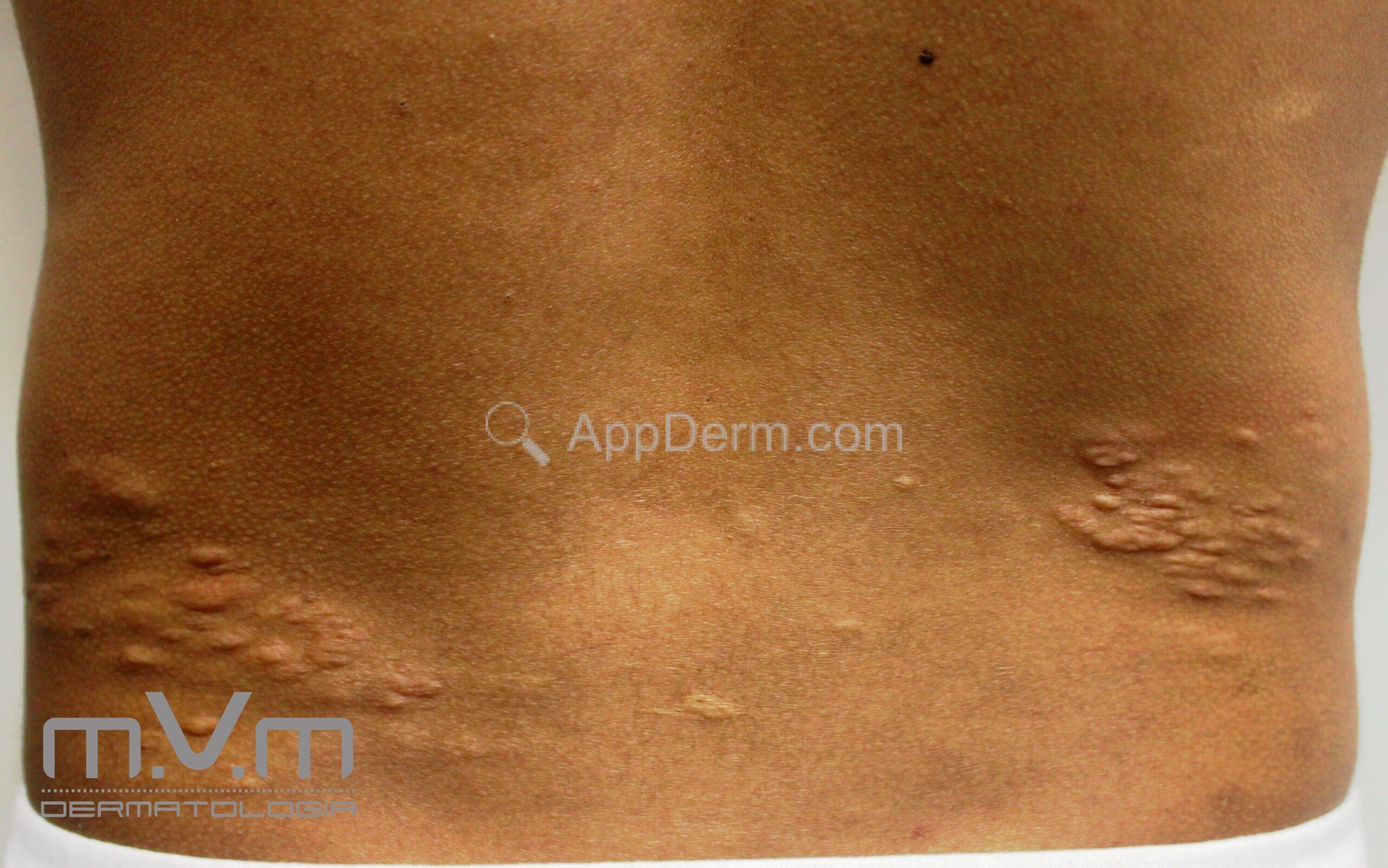 Anetodermias | Appderm