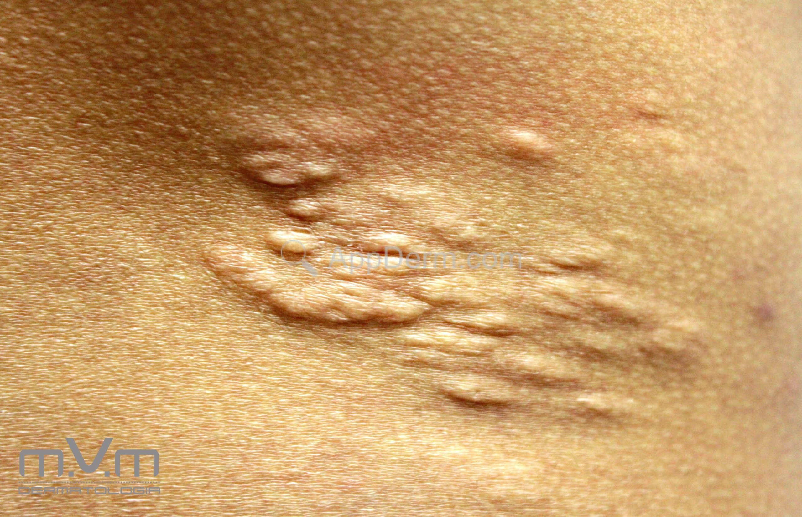 Anetodermias | Appderm