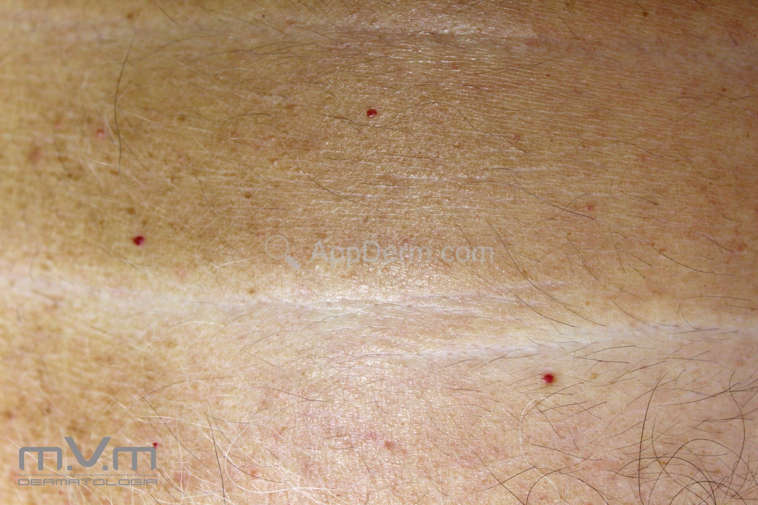 Angioma rubi (mancha de Campbell de Morgan) - AppDerm