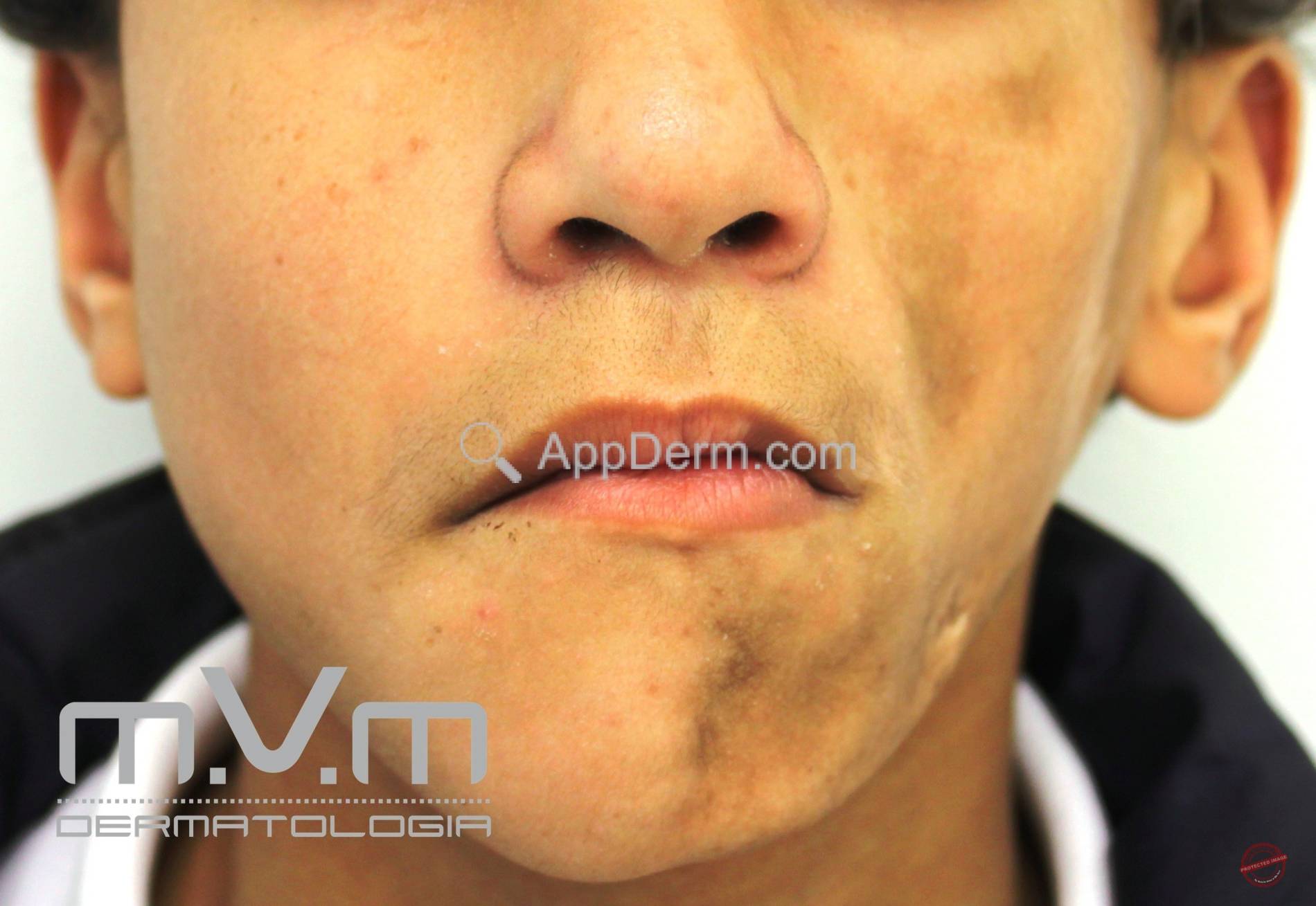 Atrofia hemifacial (síndrome de Parry-Romberg) | Appderm