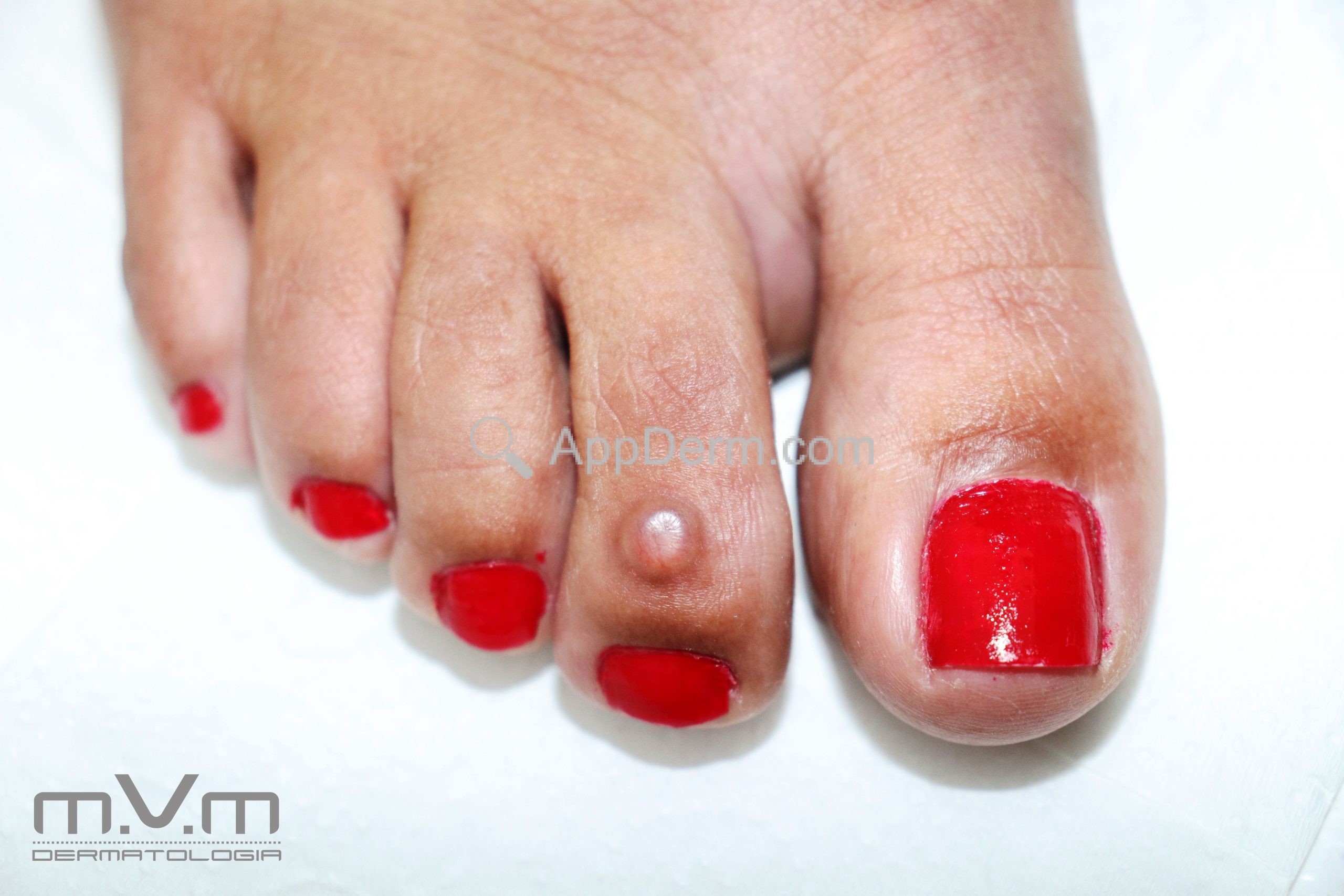 Cisto mixoide | Appderm