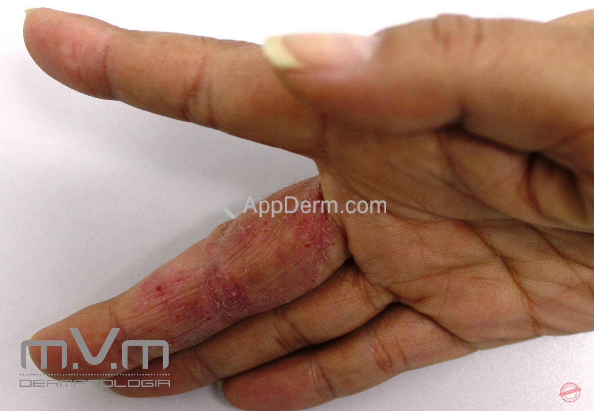 Disidrose (ponfolix) - AppDerm