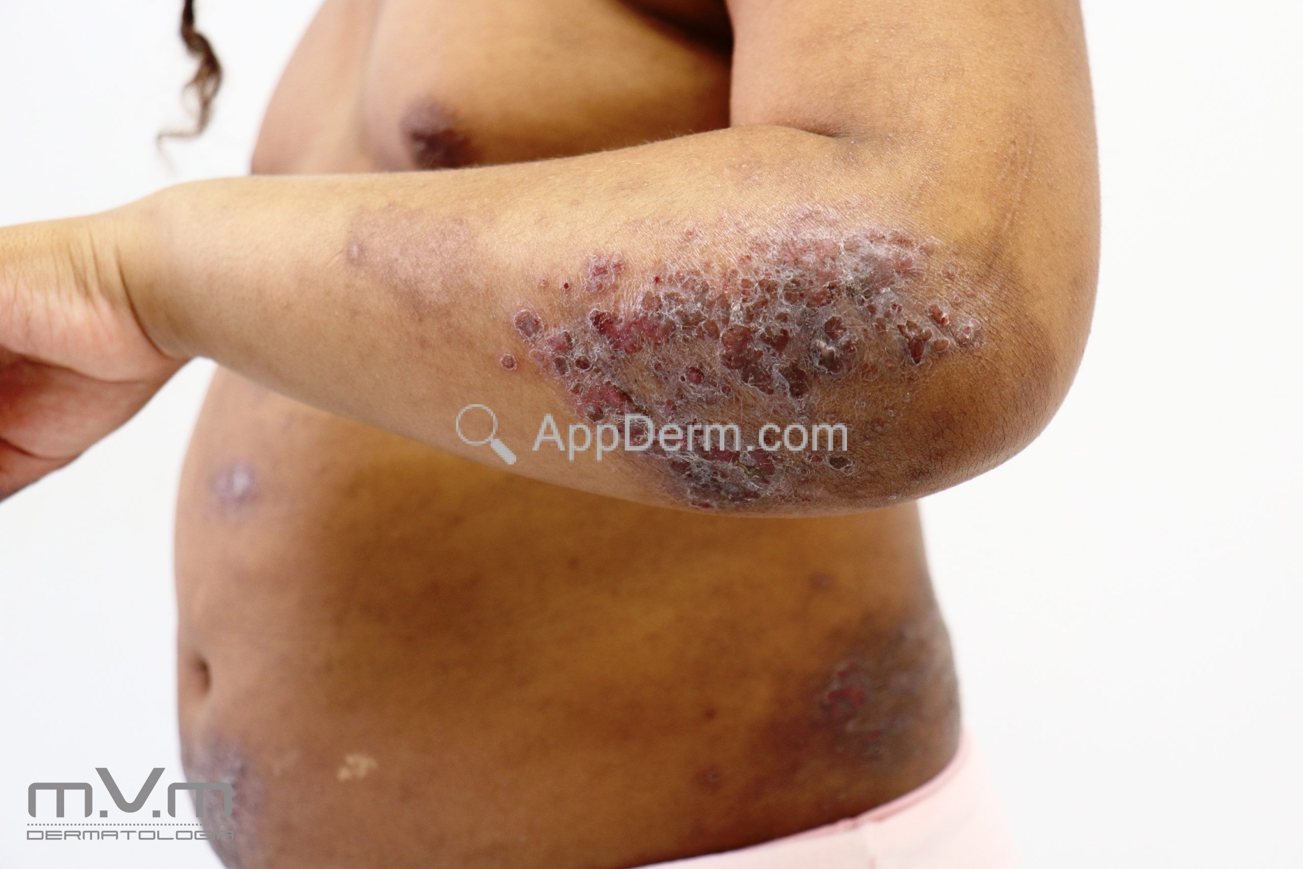 Eczema numular (dermatite numular) | Appderm