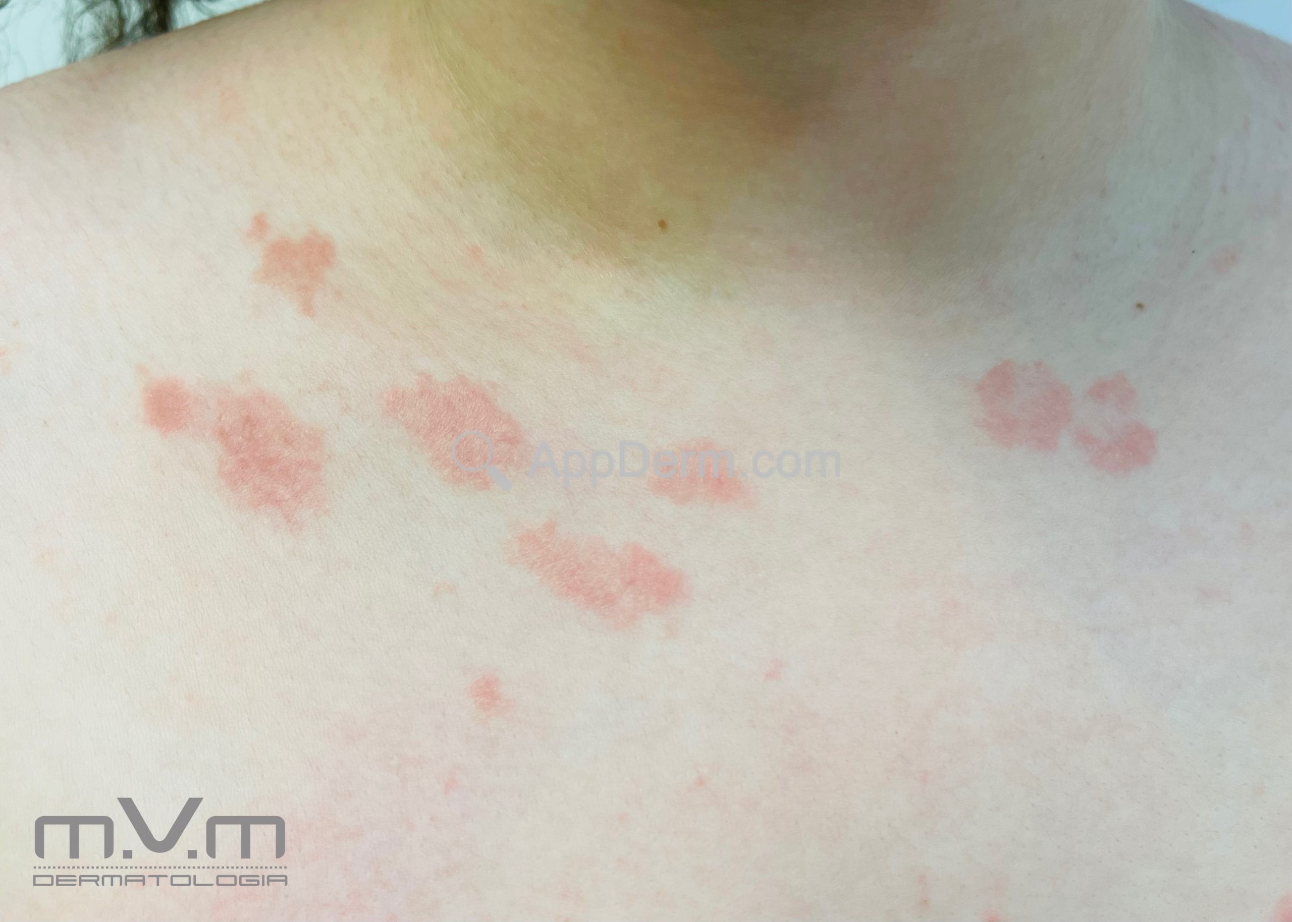Eczema numular (dermatite numular) | Appderm