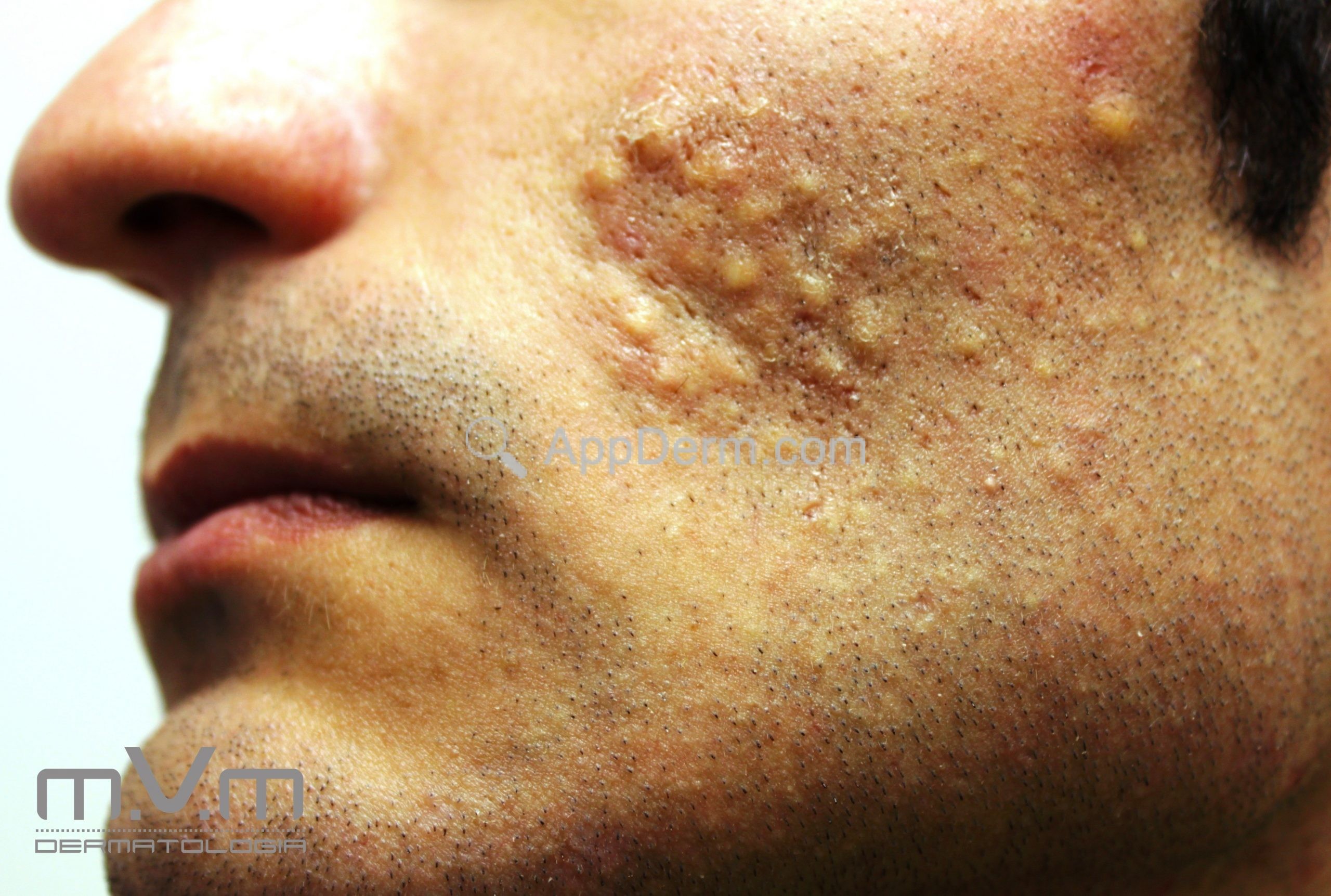 Esteatocistoma | Appderm