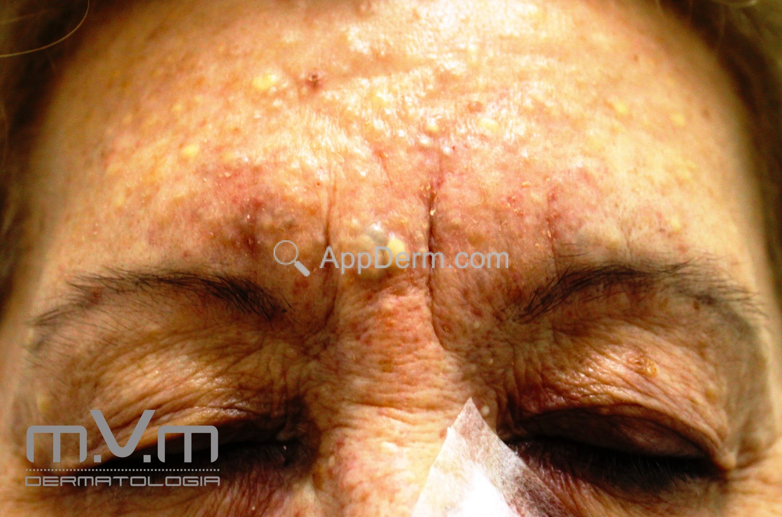 Esteatocistoma | Appderm