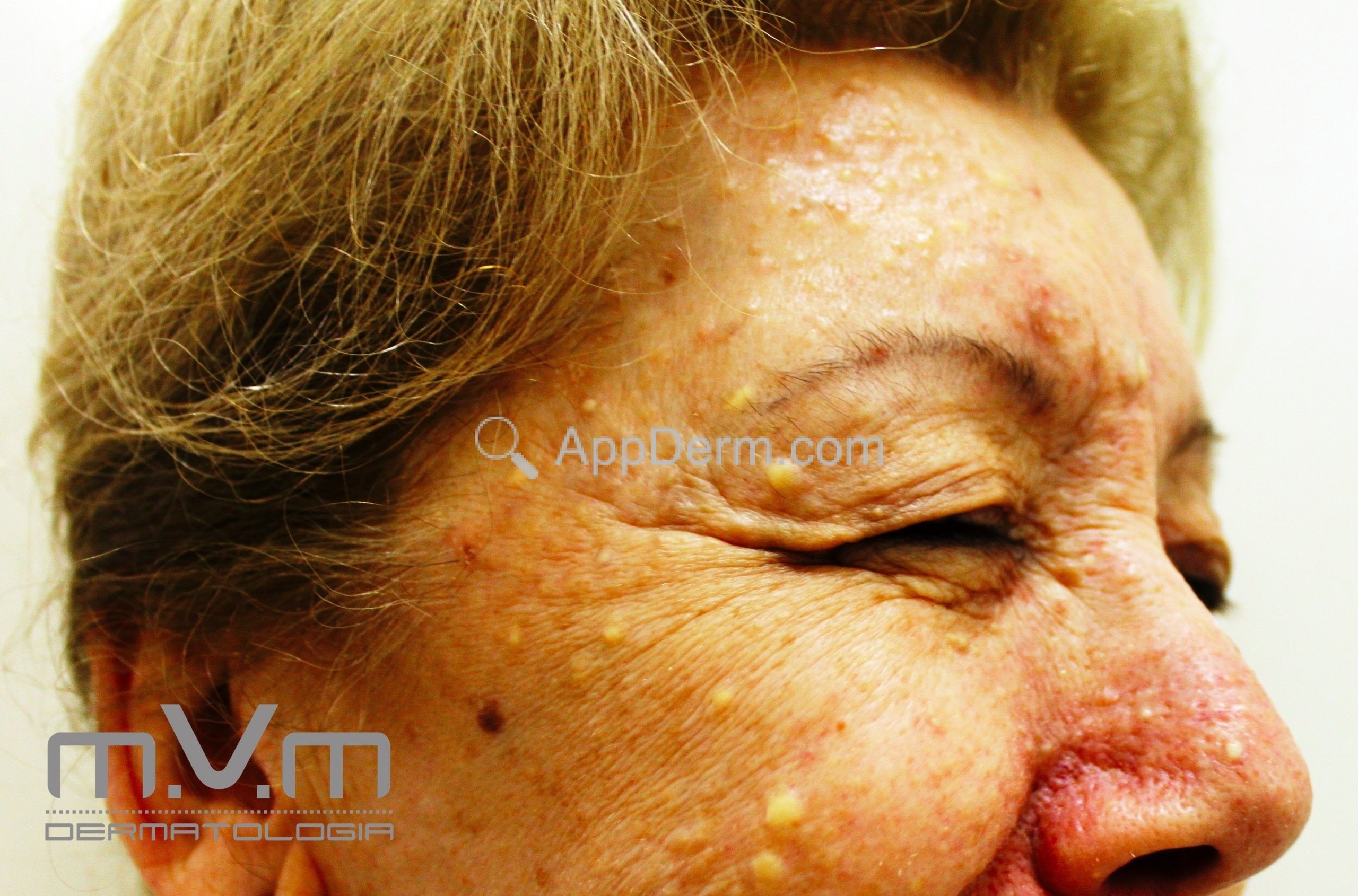 Esteatocistoma | Appderm