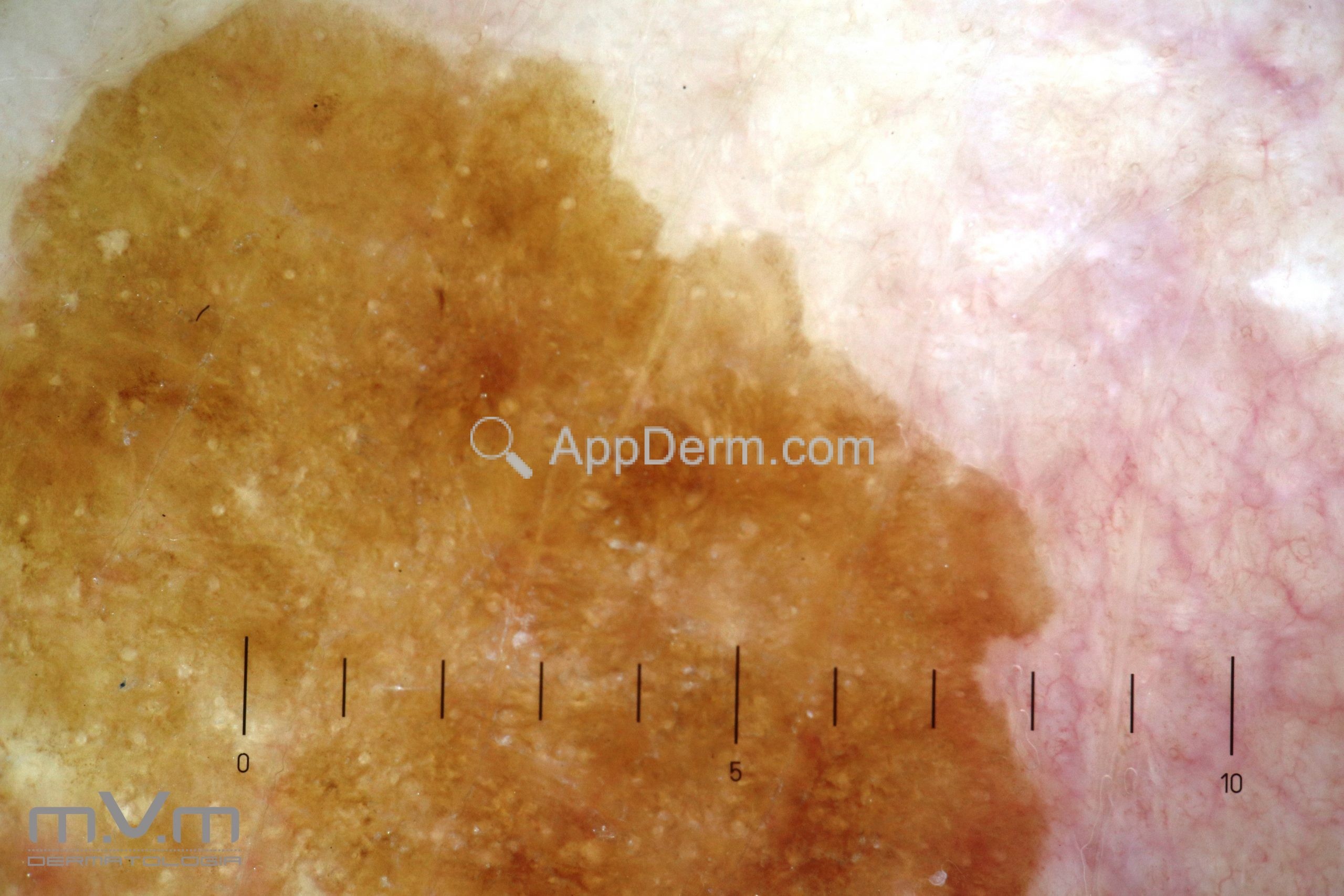 Lentigo solar (melanose solar) | Appderm