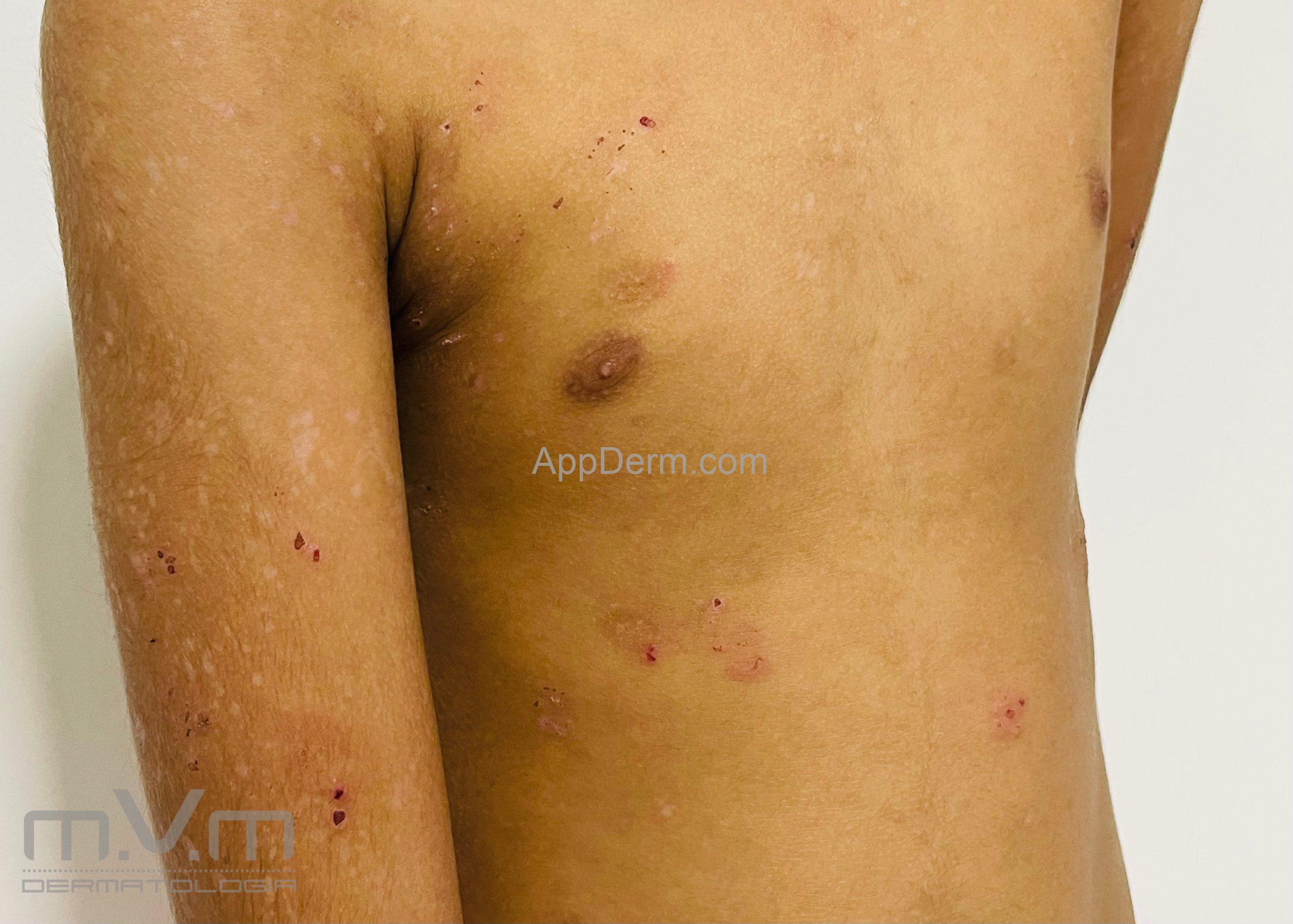Dermatose bolhosa IgA linear | Appderm