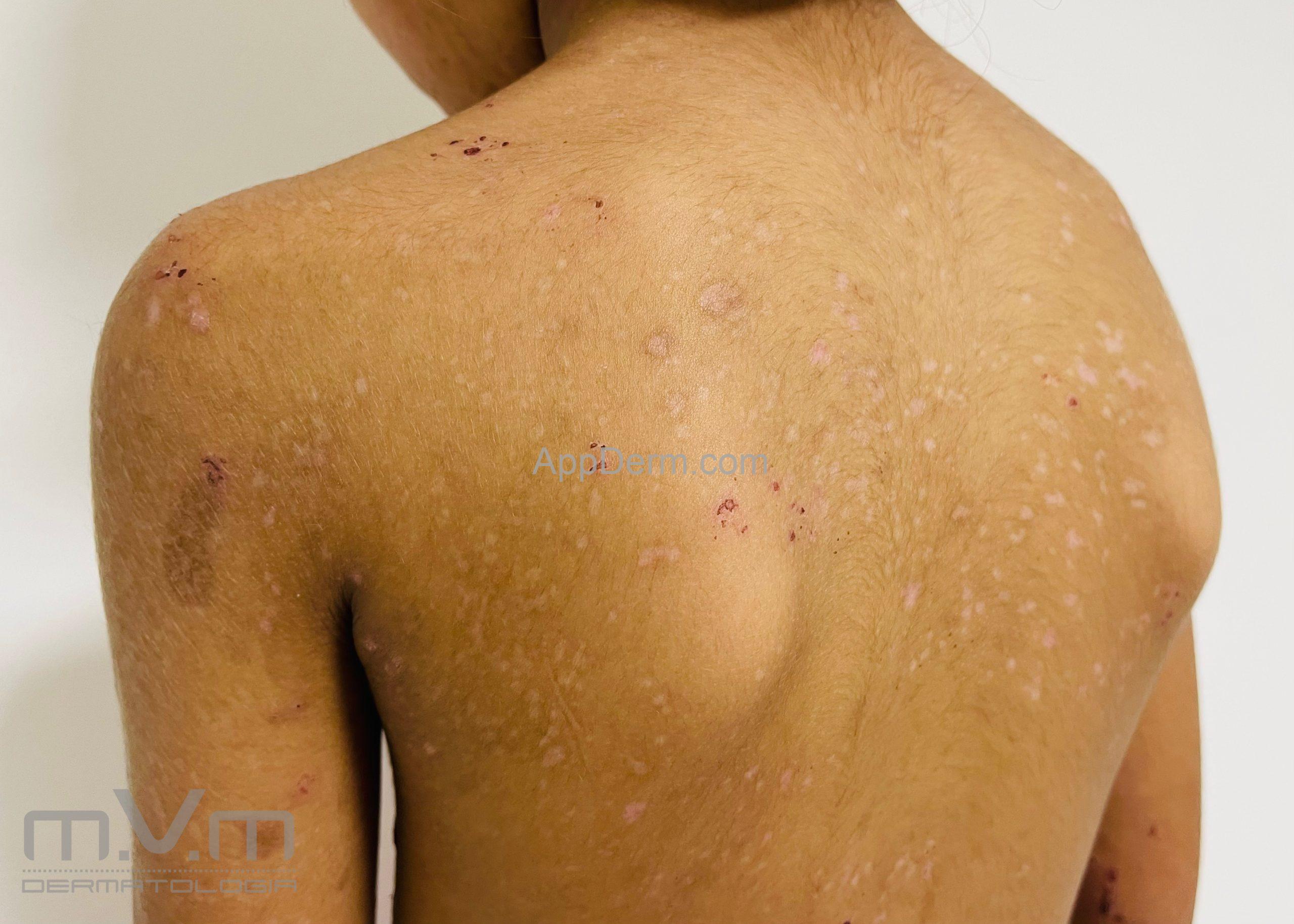 Dermatose bolhosa IgA linear | Appderm