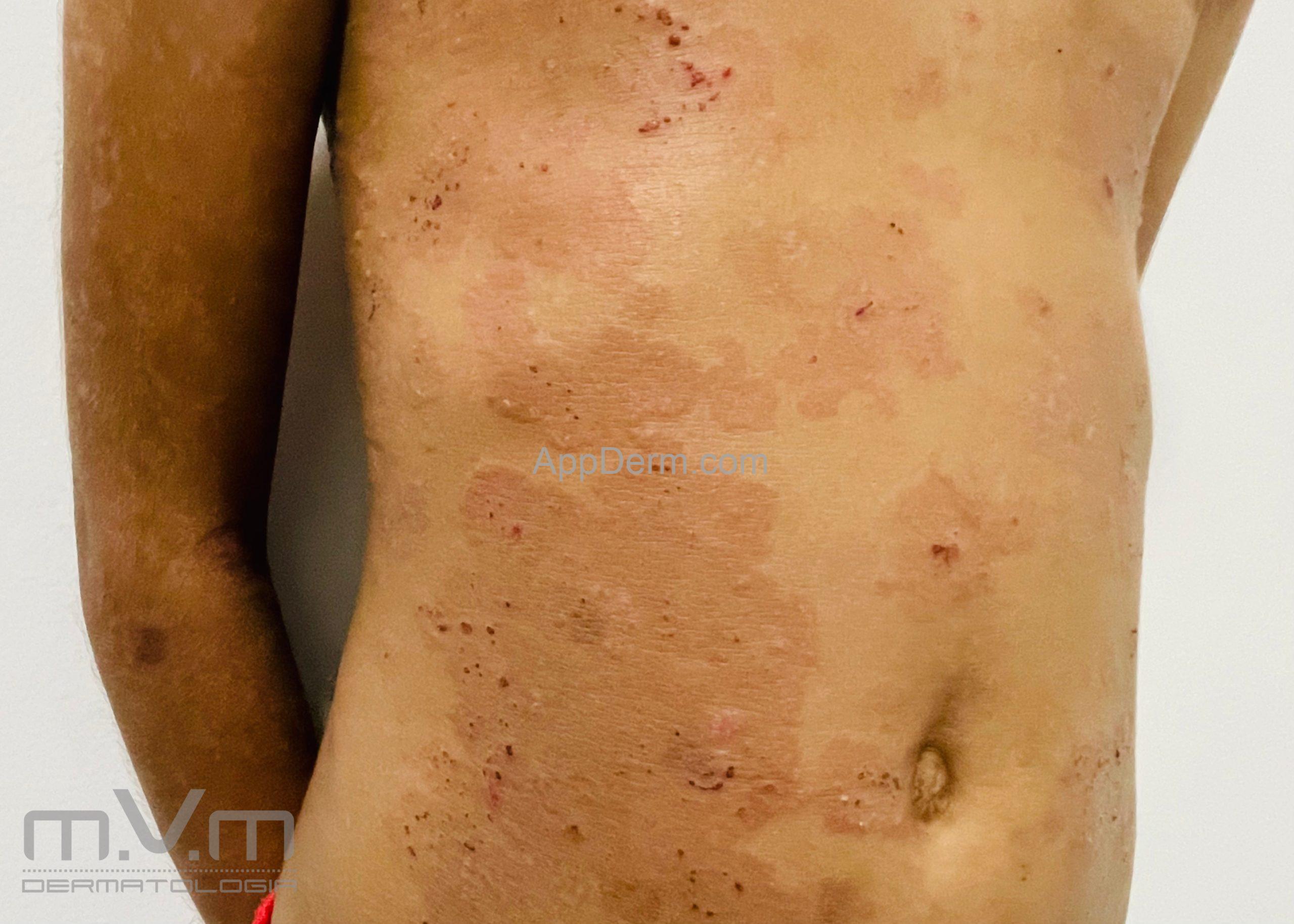 Dermatose bolhosa IgA linear | Appderm