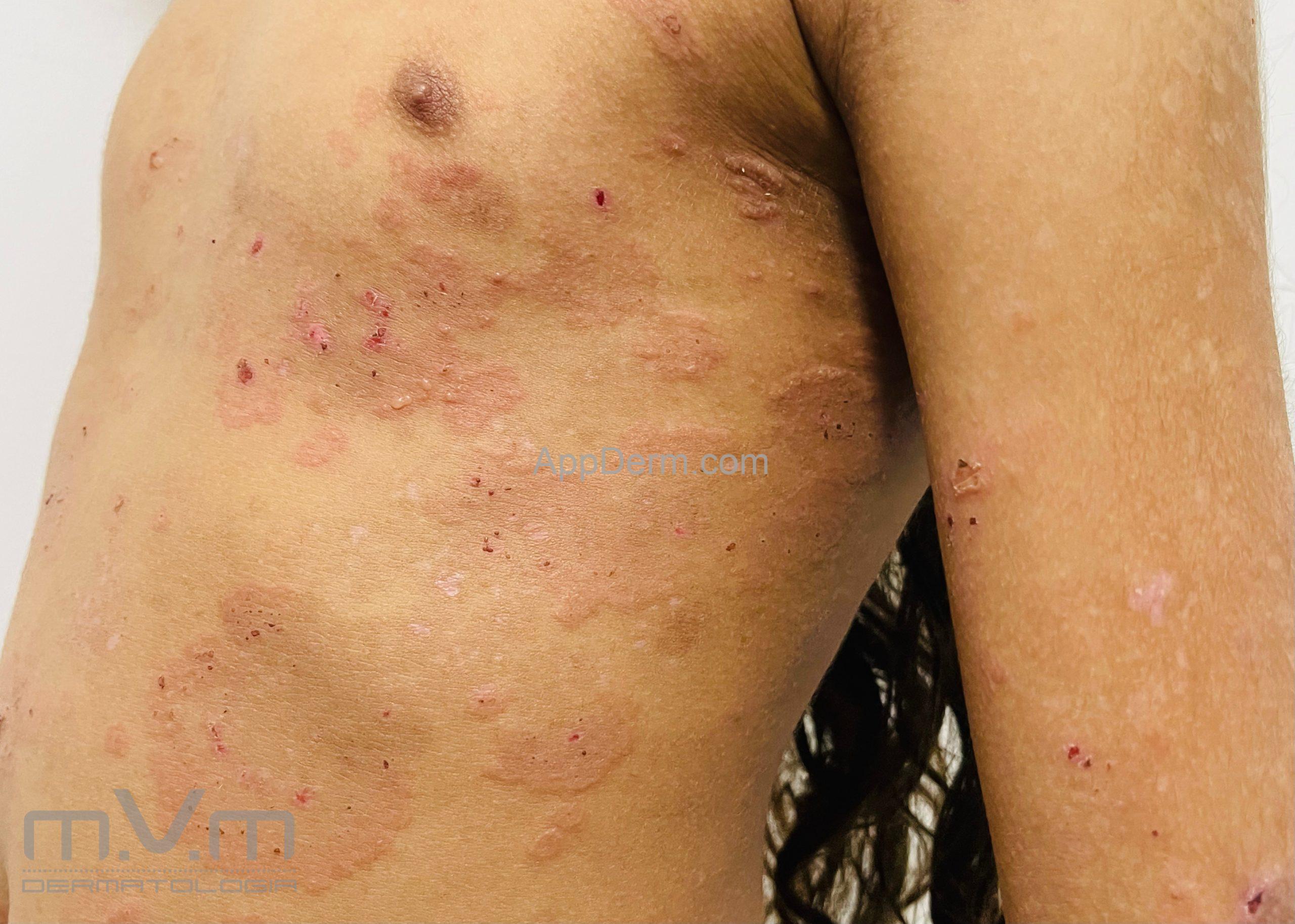 Dermatose bolhosa IgA linear | Appderm